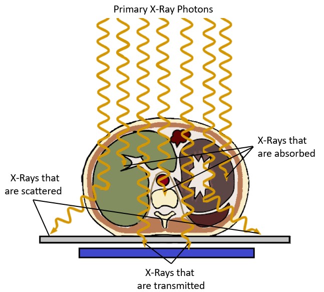 Grids And Beam Restriction Digital Radiographic Exposure Principles And Practice